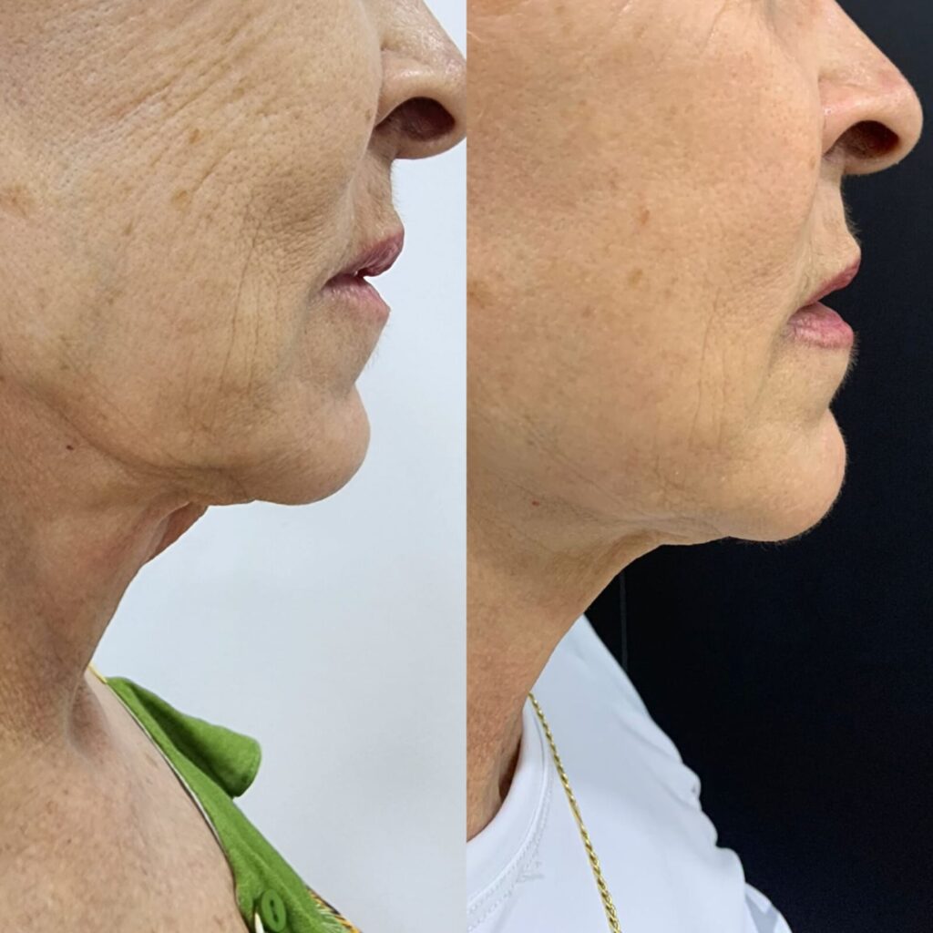 ENDOLASER – draelyeleres.com.br